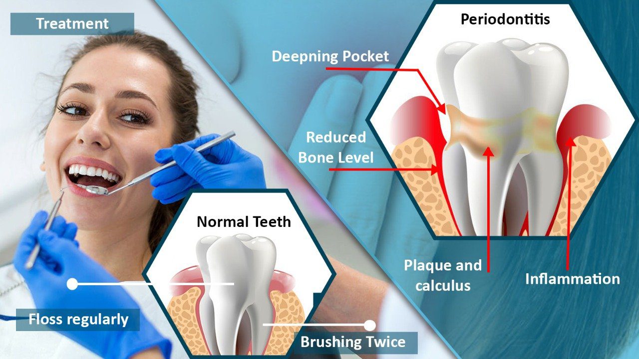 Periodontitis: Gum Disease Symptoms, Treatment, and Prevention